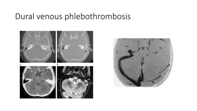 Complications of mastoiditis | PPTX | Ear, Nose and Throat Conditions ...