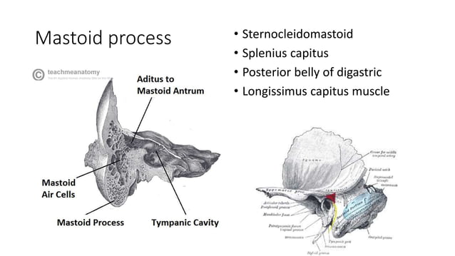 Complications of mastoiditis | PPTX | Ear, Nose and Throat Conditions ...