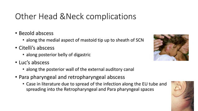 Complications of mastoiditis | PPTX | Ear, Nose and Throat Conditions ...