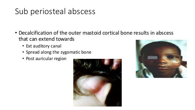 Complications of mastoiditis