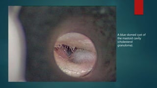 Complications of mastoid surgery | PPTX