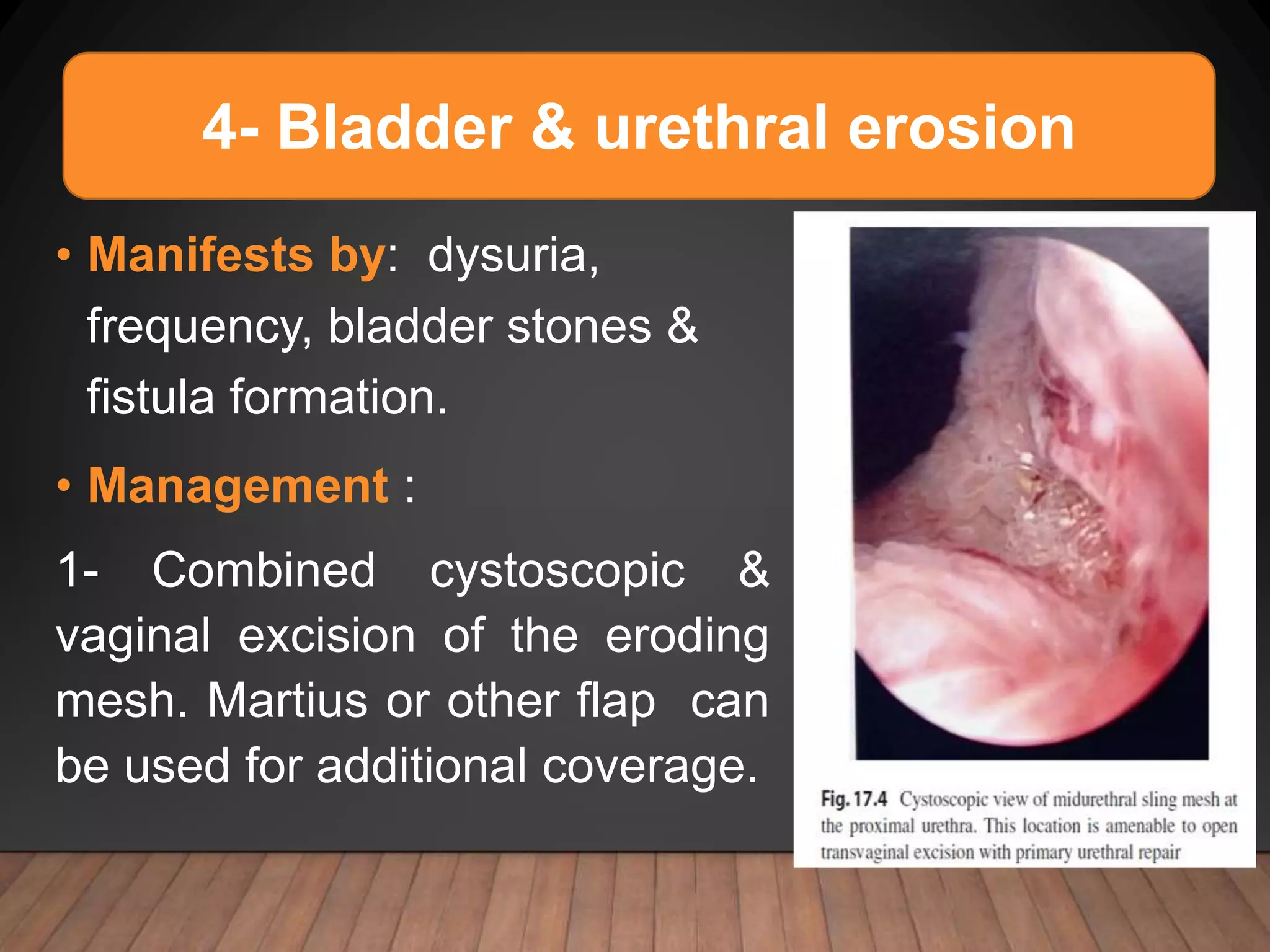 Complications of mesh in gynecologic surgery | PPTX