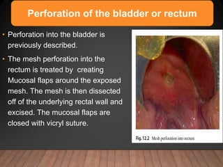 Complications of mesh in gynecologic surgery | PPTX