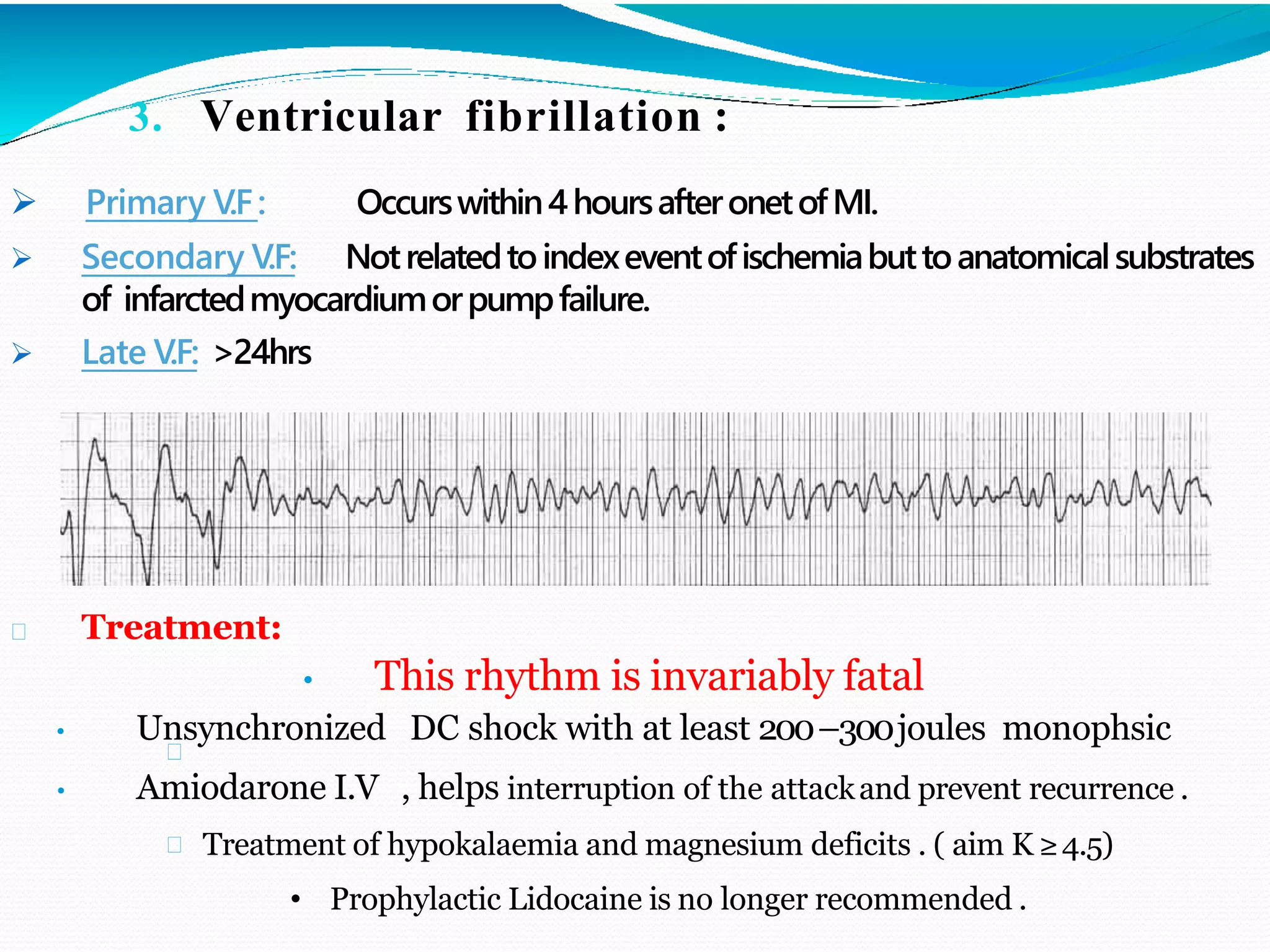 Complications of MI and their managements | PPTX