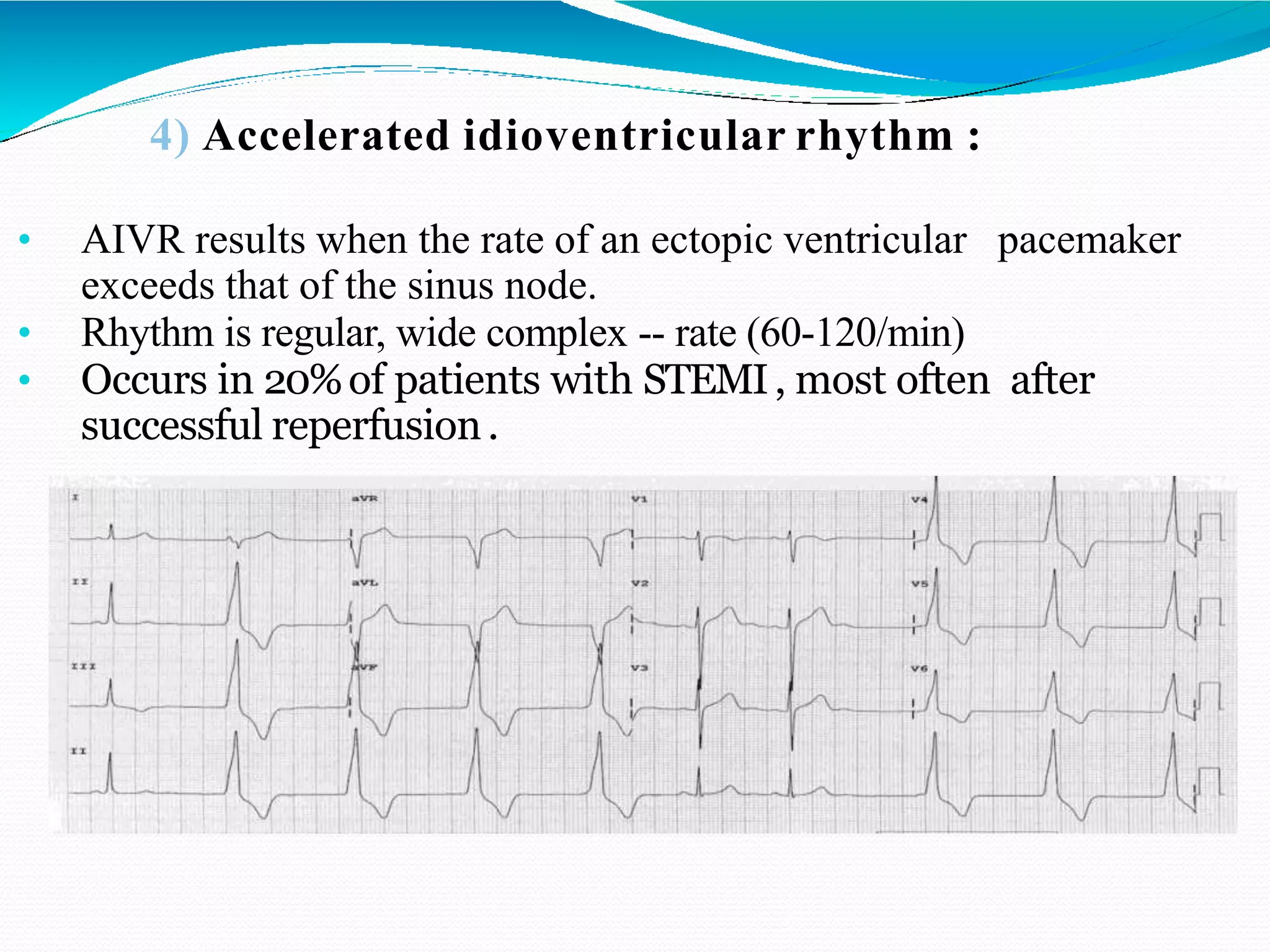 Complications of MI and their managements | PPTX