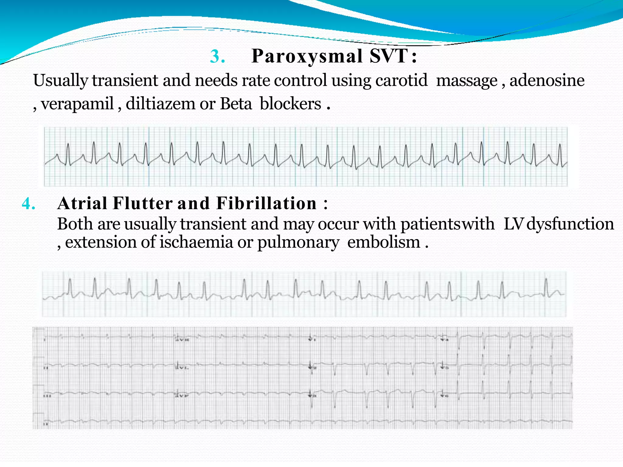 Complications of MI and their managements | PPTX