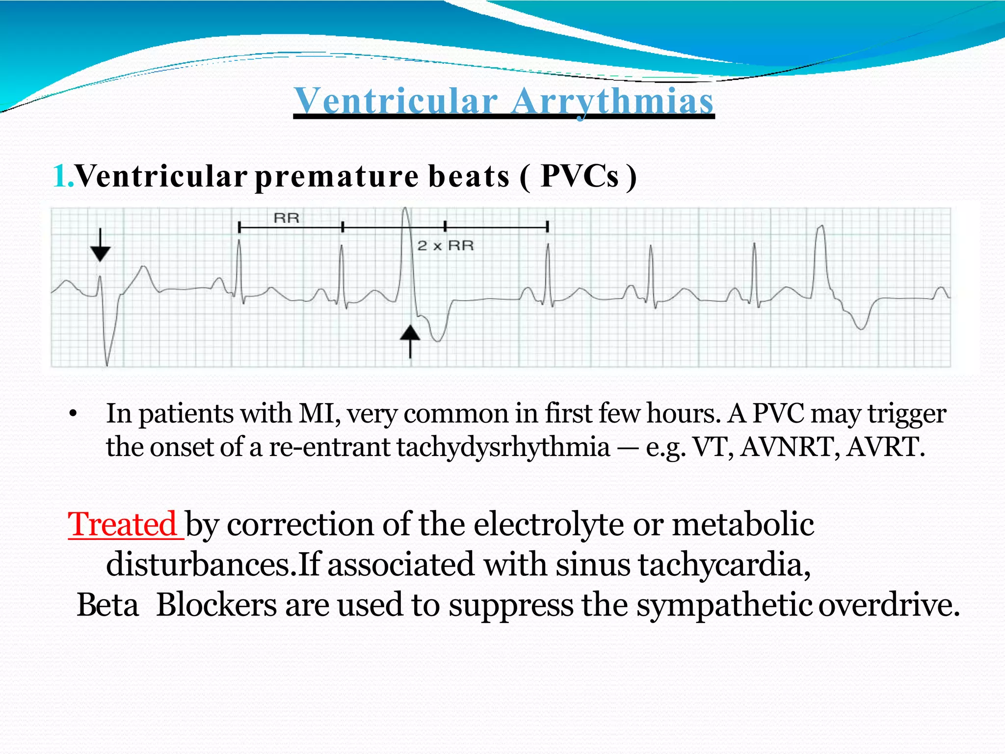Complications of MI and their managements | PPTX