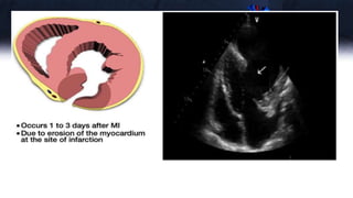 Complications of MI.pptx