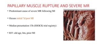 COMPLICATIONS OF MI (1)myocardial infarction.pptx