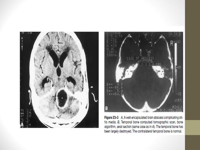 Complications of chronic otitis media | PPT