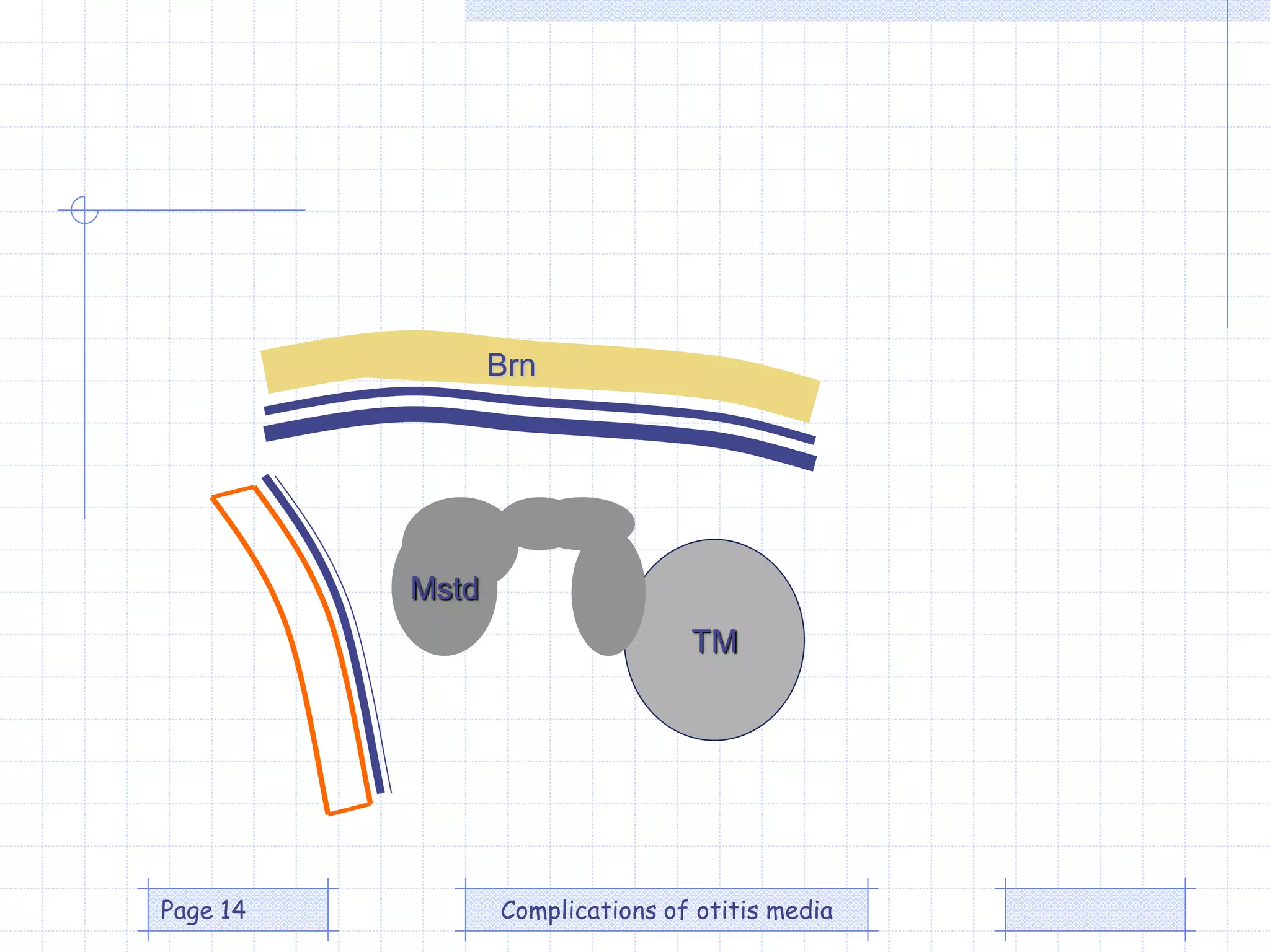 Complications of otitis media | PPT