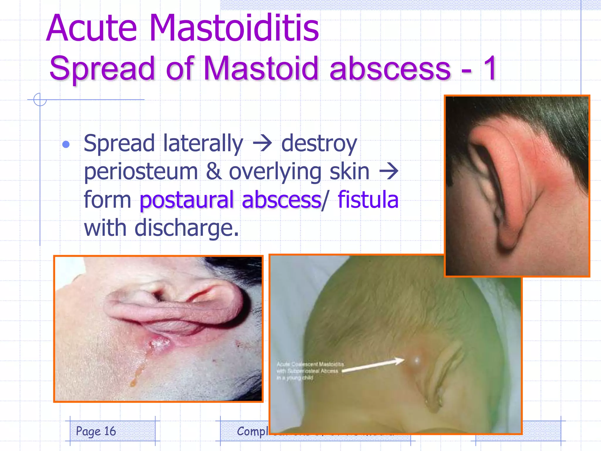 Complications of otitis media | PPT