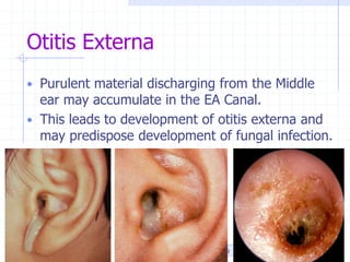 Chronic Otitis Media Complications