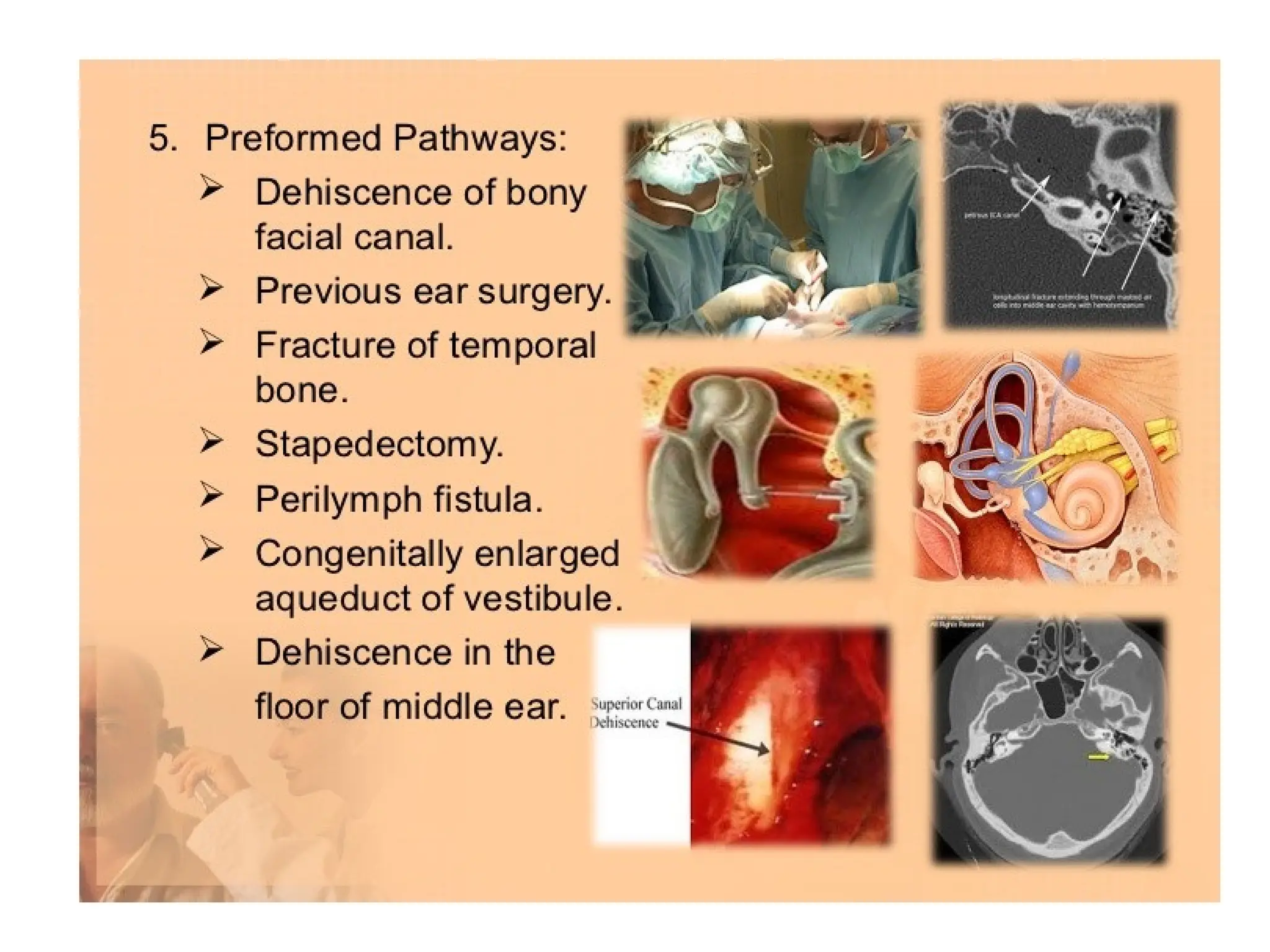 complications of otitis media-intracranial and extracranial | PPT