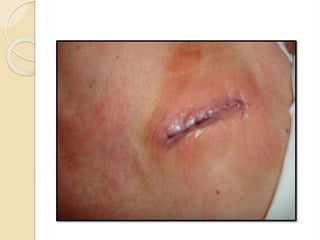 Complications of pacemaker implantation. Waleed Roshdy | PPTX