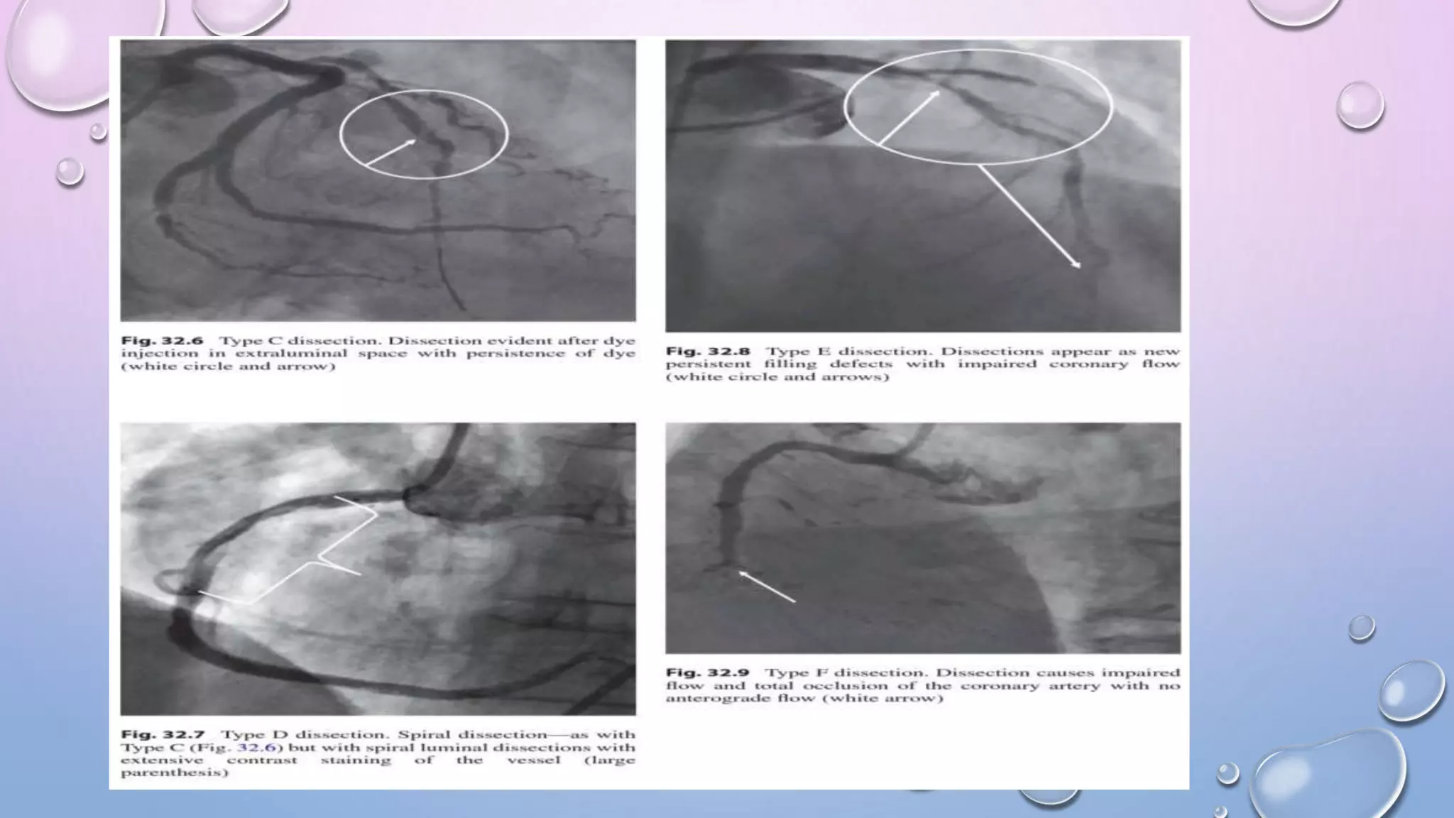 Complications of PCI-Dr. Sushil.pptx