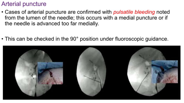 COMPLICATIONS OF PCNL.pptx | First Aid | Injuries