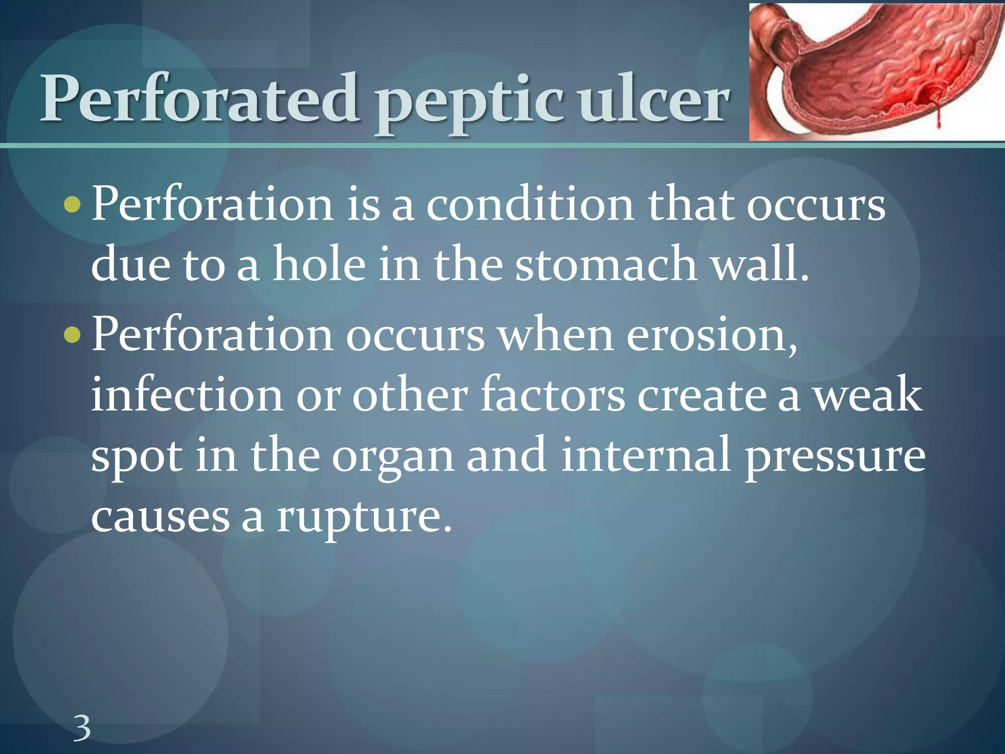 Complications of peptic ulcer | PDF