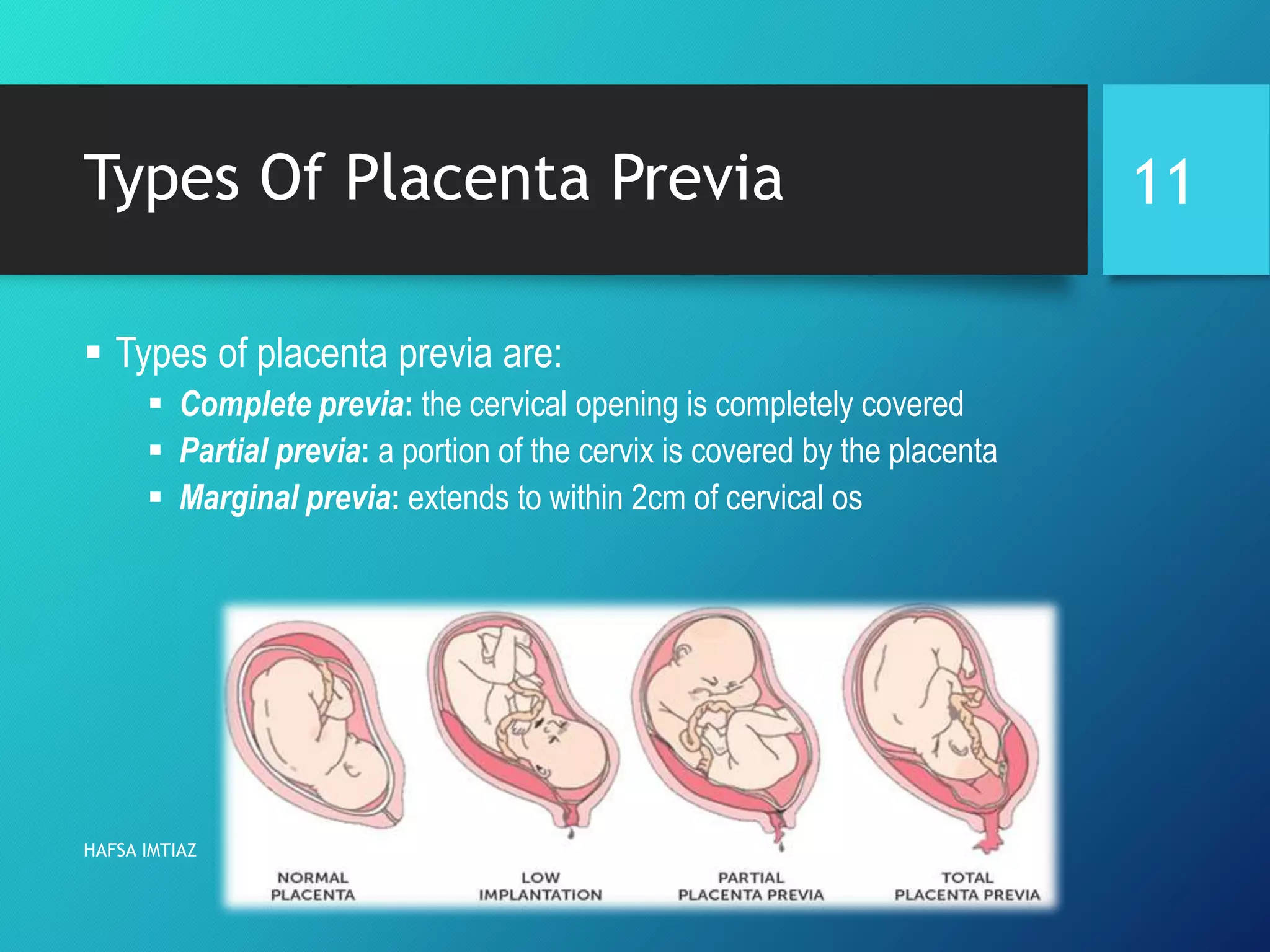 Complications of pregnancy | PPTX
