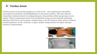 Complications of Prone Position For Anesthetized Patient - Copy.pptx