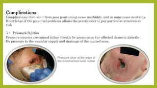 Complications of Prone Position For Anesthetized Patient - Copy.pptx