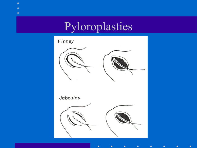 Complications of pud | PPT | Digestive Disorders | Diseases and Conditions