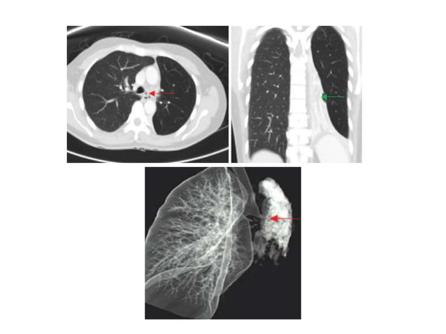 Complications of pulmonary tb | PPTX | Lung and Respiratory Health ...