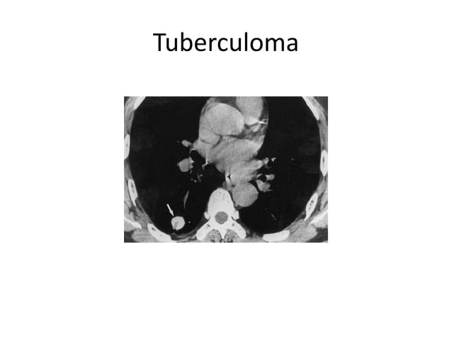 Complications of pulmonary tb | PPTX | Lung and Respiratory Health ...