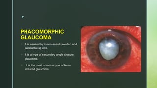 Complications of senile cataract .pptx