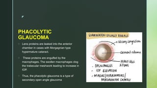 Complications of senile cataract .pptx