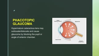 Complications of senile cataract .pptx