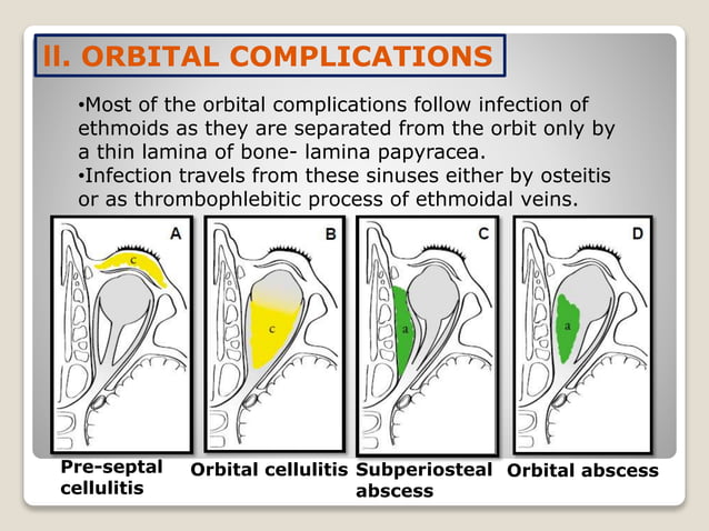 Complications of sinusitis | PPTX | Ear, Nose and Throat Conditions ...