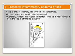 Complications of sinusitis | PPTX