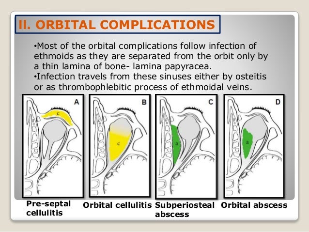 Complications of sinusitis