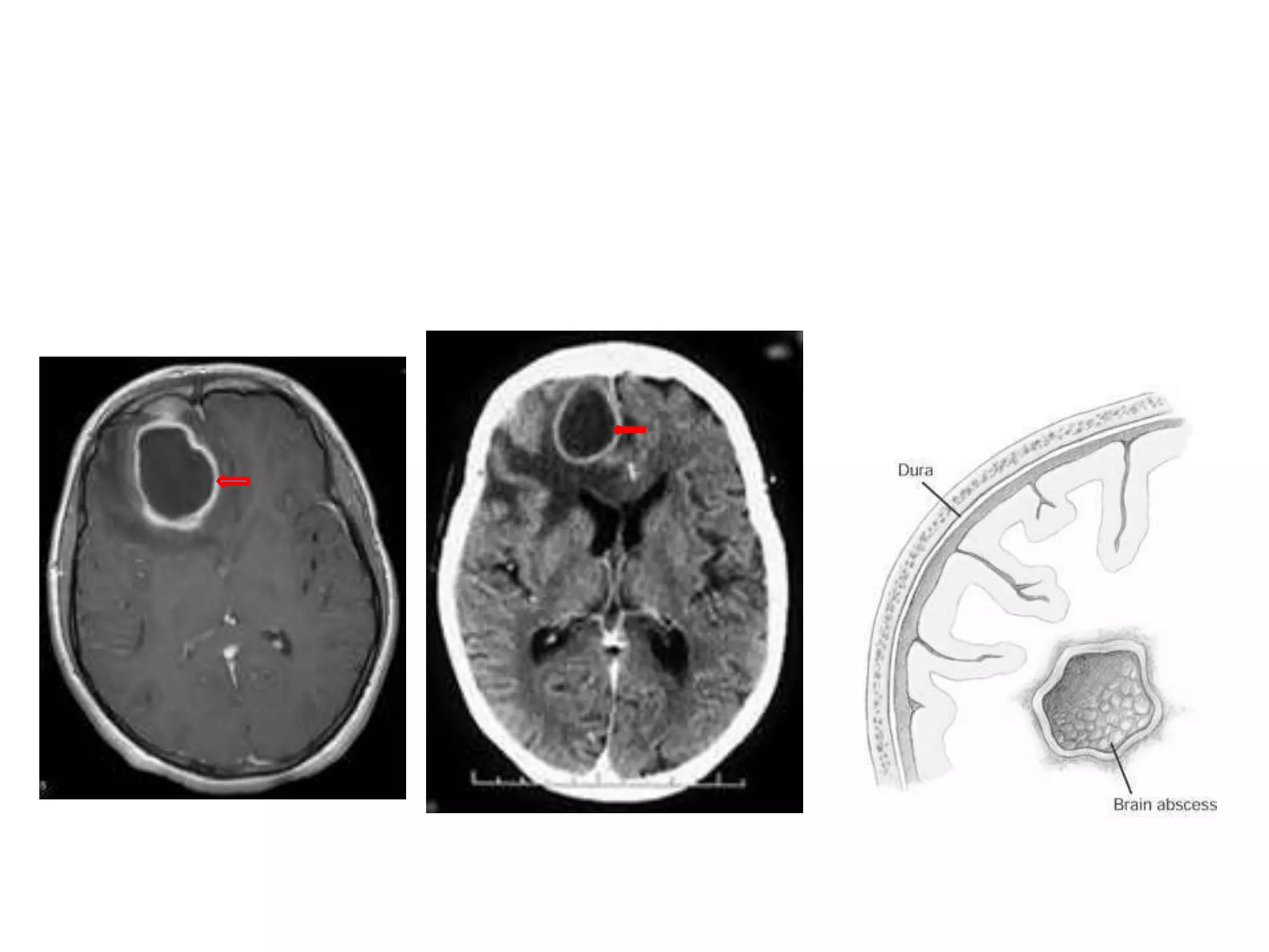 Complications of sinusitis | PPTX