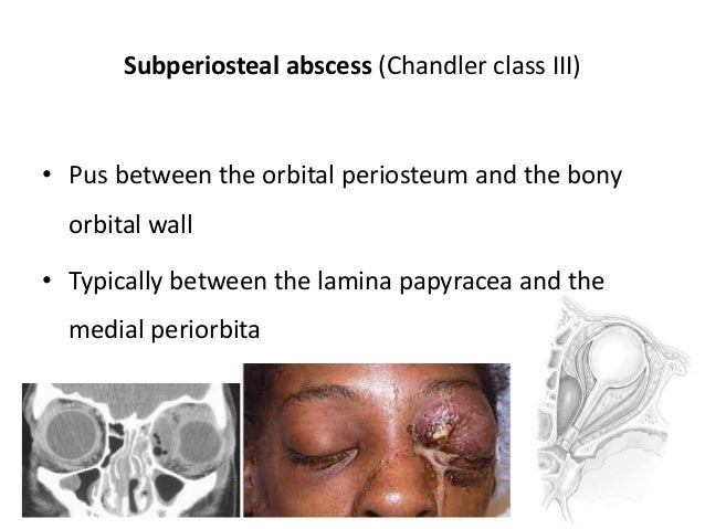 Subperiosteal Abscess