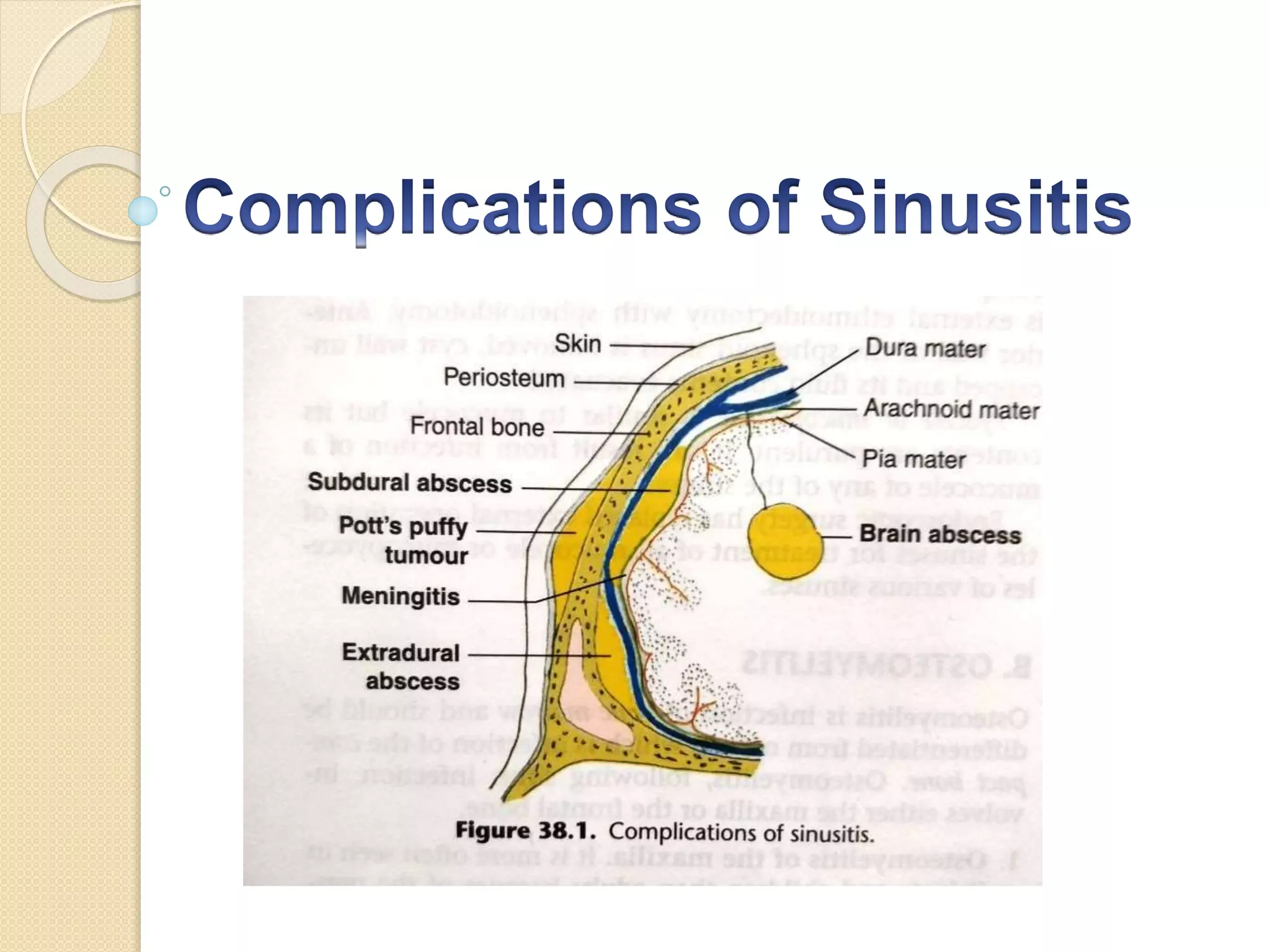 Complications of sinusitis | PPTX | Ear, Nose and Throat Conditions ...