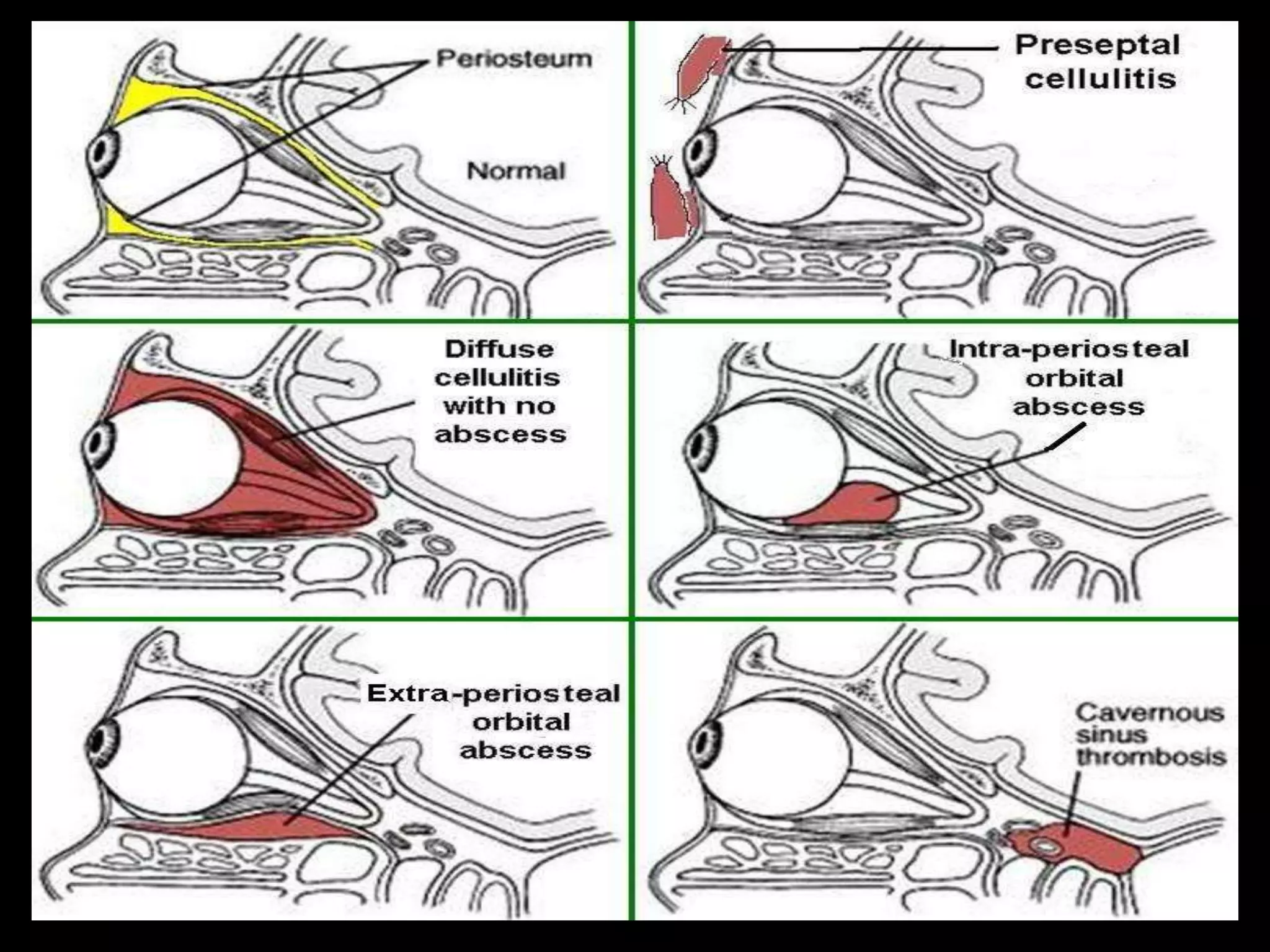 Complications of sinusitis | PPT