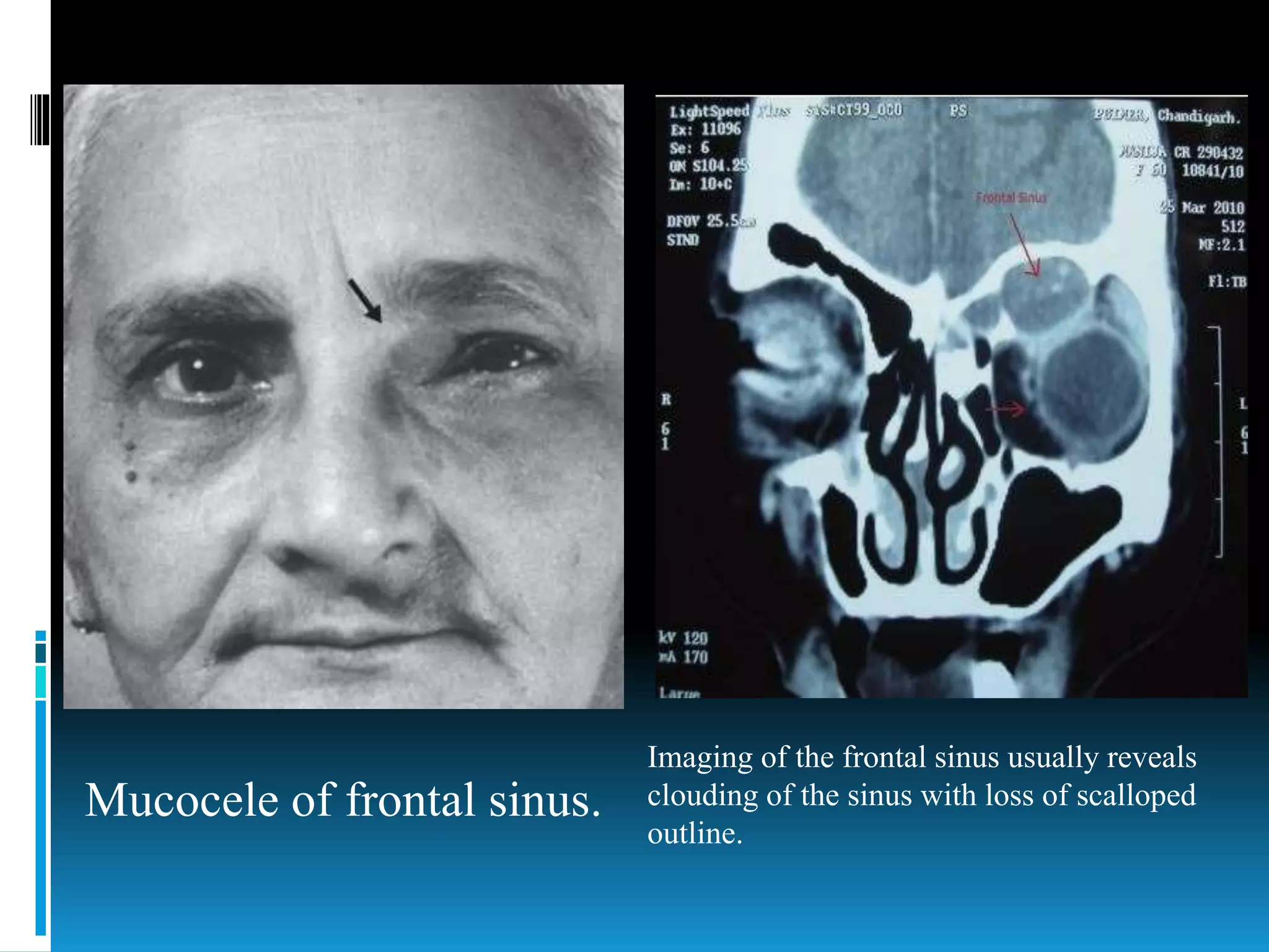 Complications of sinusitis | PPTX
