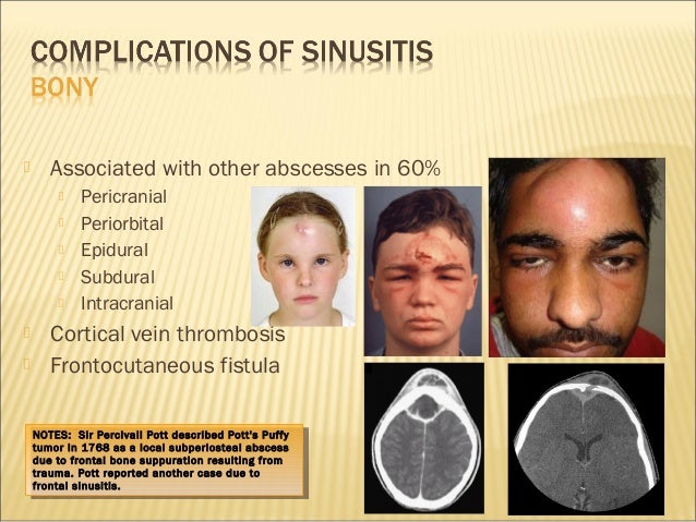 Complications of sinusitis 23.05.16- dr.sithanadhakumar