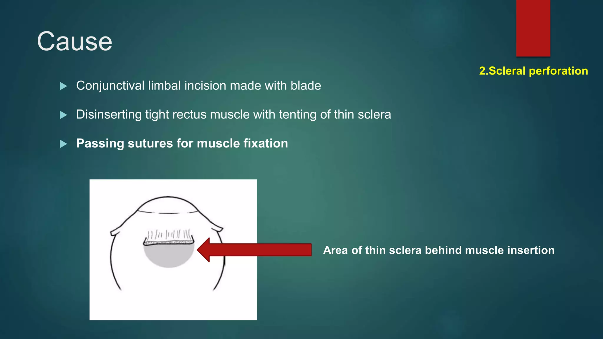 Complications of squint sx | PPTX