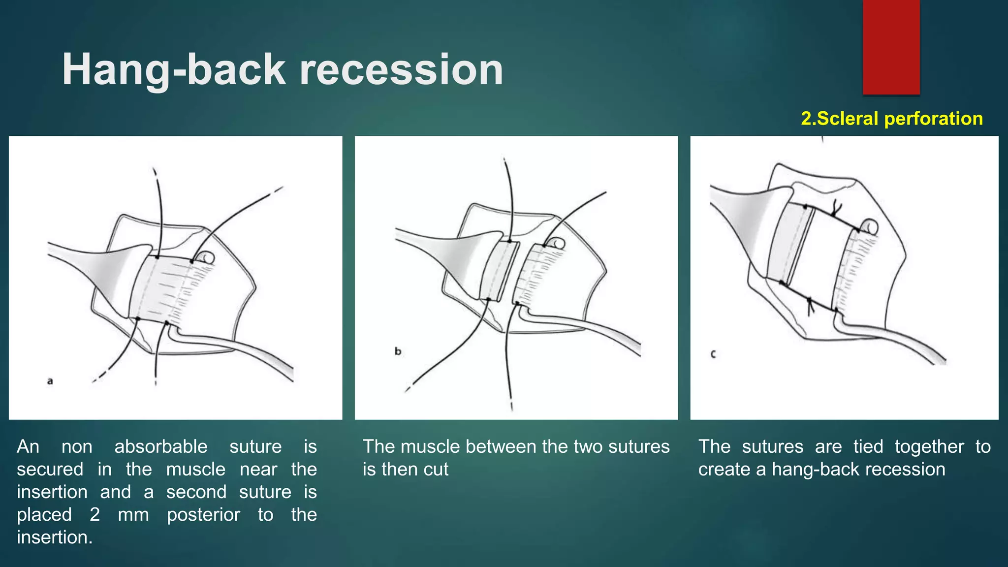 Complications of squint sx | PPTX