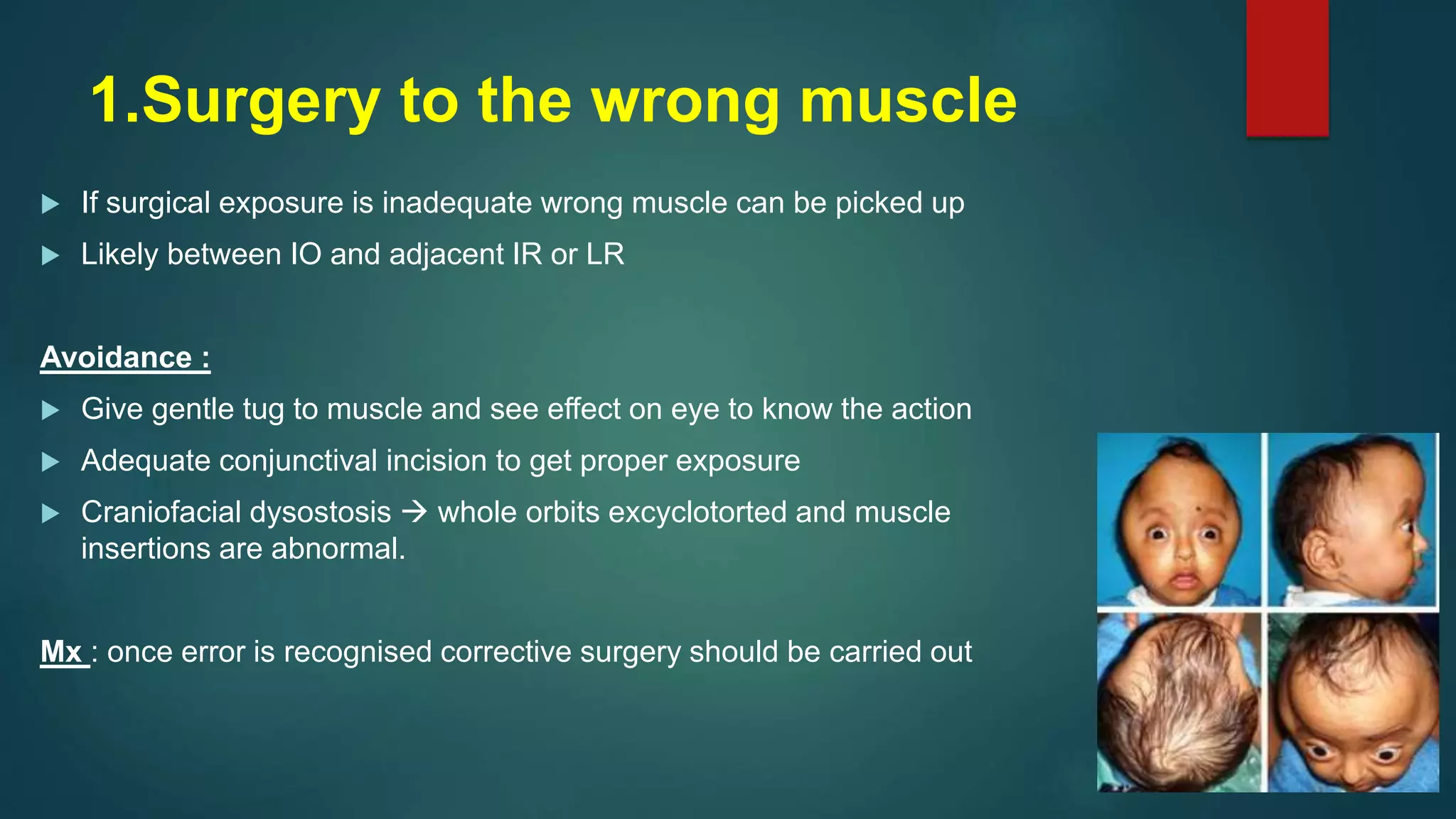 Complications of squint sx | PPTX