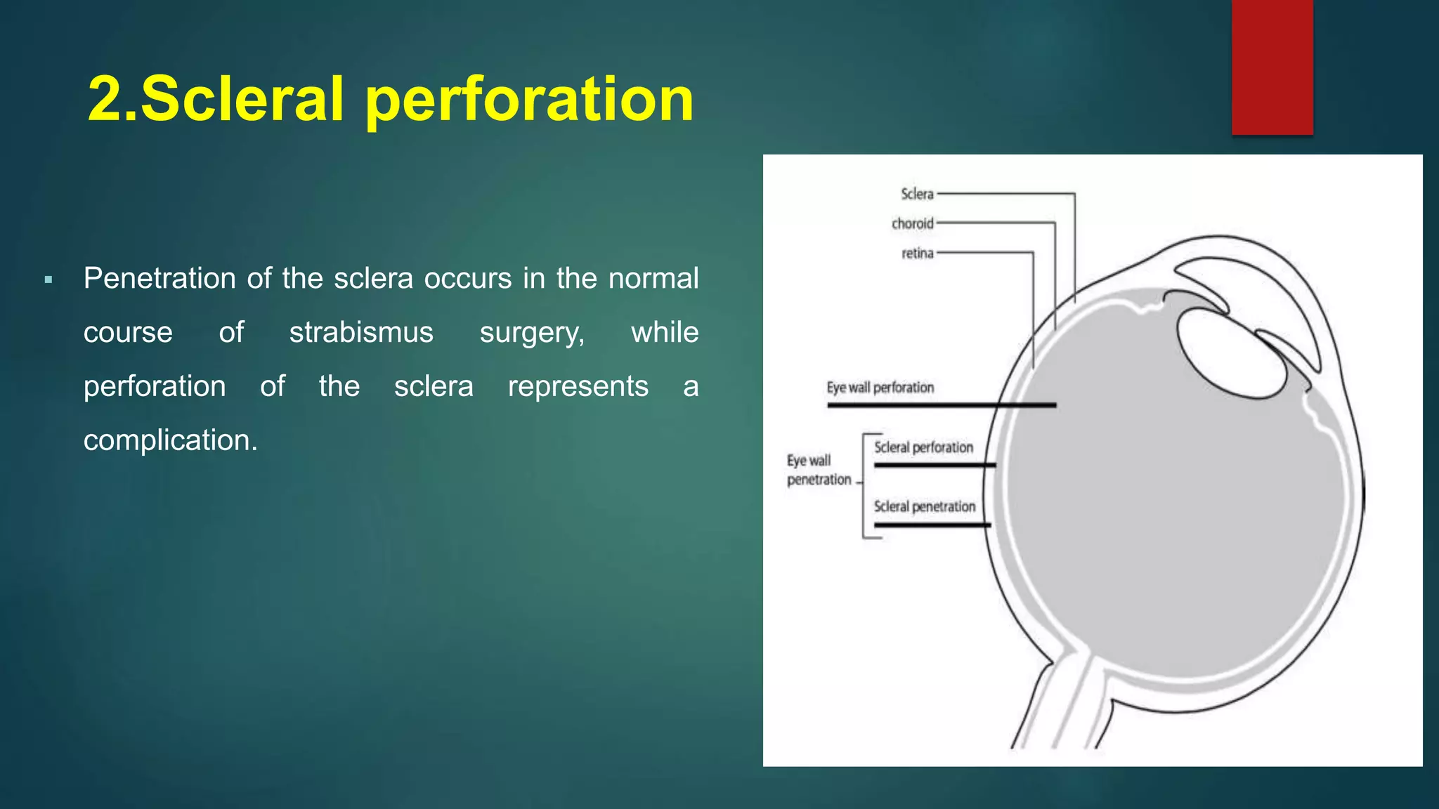 Complications of squint sx | PPTX