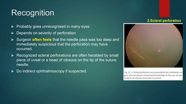 Complications of squint sx | PPTX | Eye and Vision Conditions ...