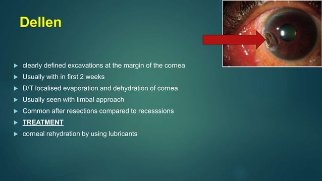 Complications of squint sx | PPTX | Eye and Vision Conditions ...