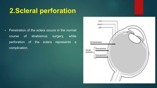 Complications of squint sx | PPTX