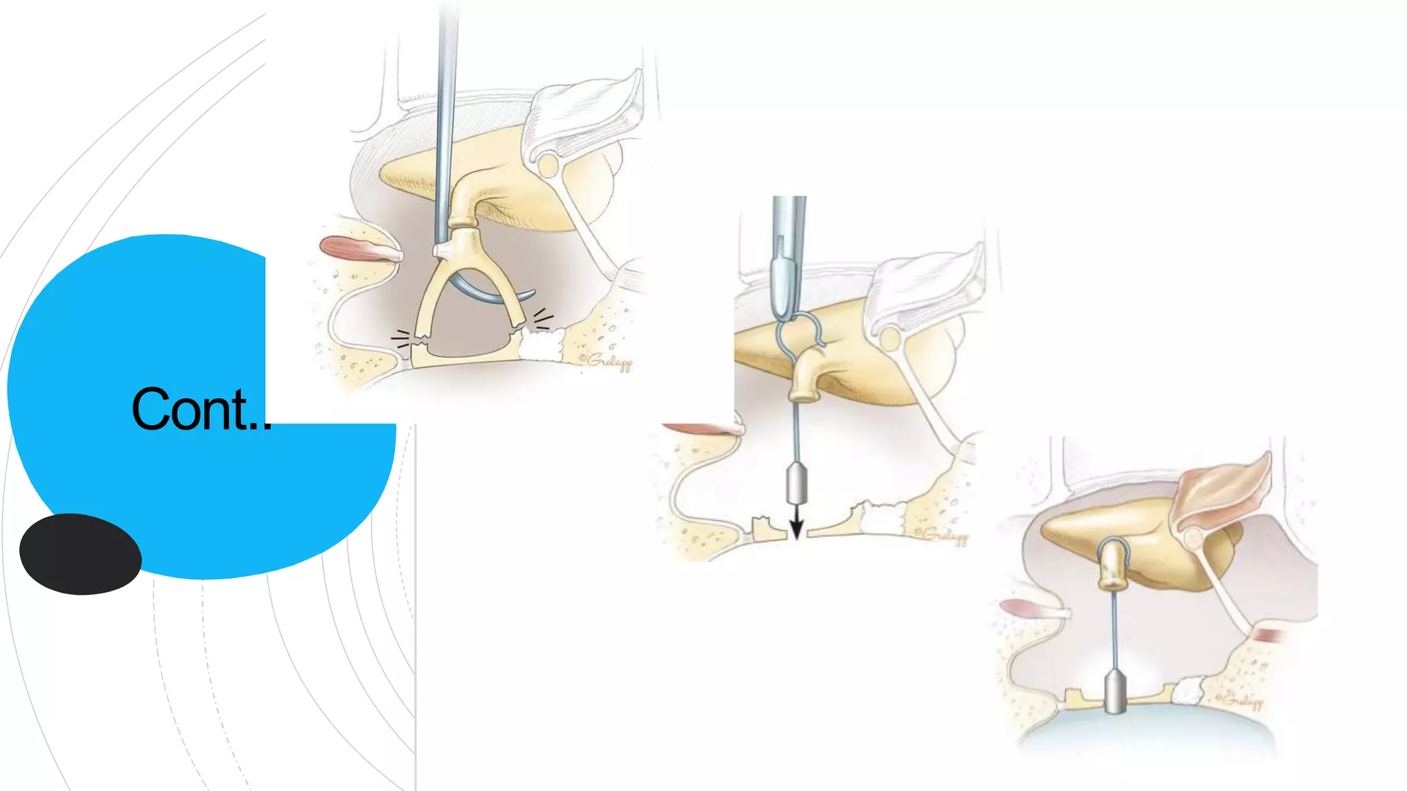 Complications of Stapes surgery.pptx