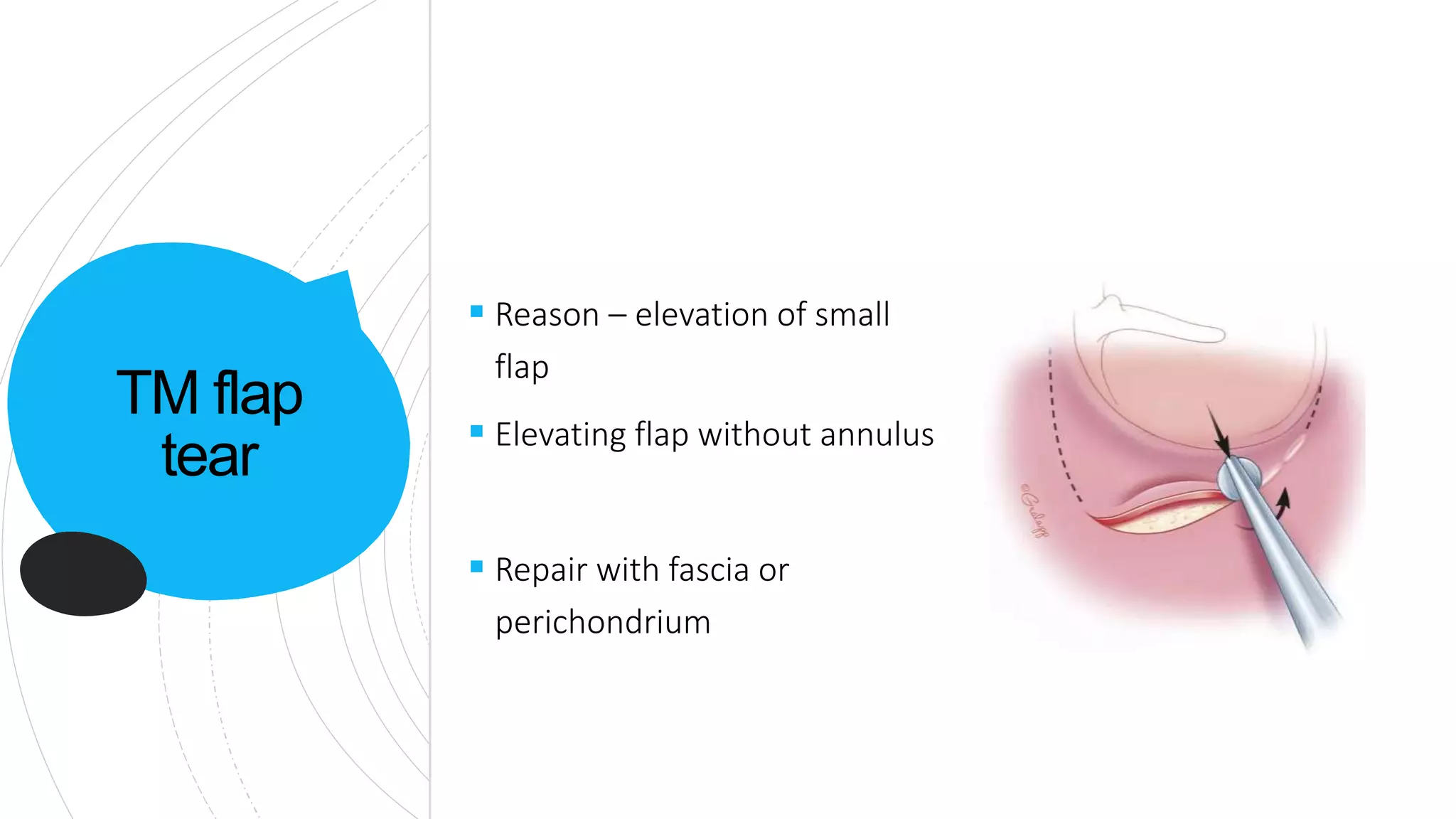 Complications of Stapes surgery.pptx | Ear, Nose and Throat Conditions ...