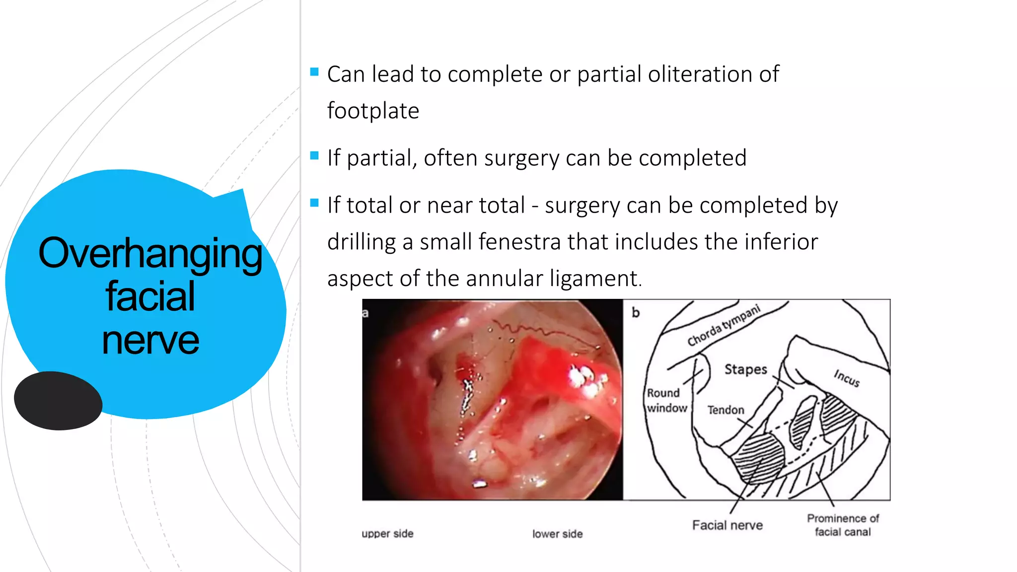 Complications of Stapes surgery.pptx | Ear, Nose and Throat Conditions ...